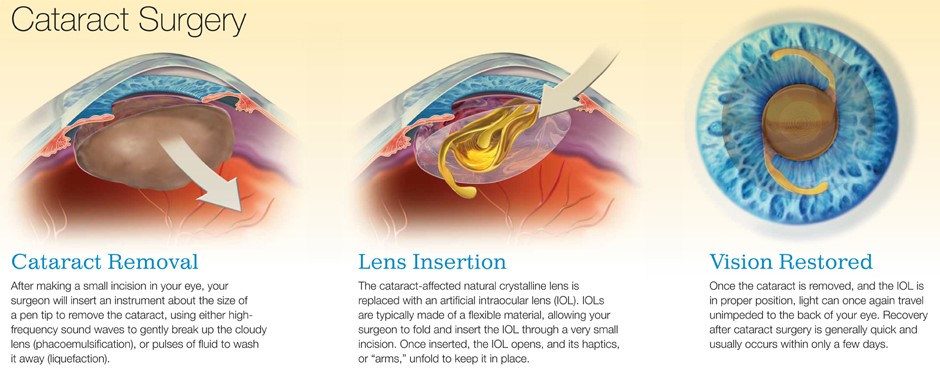 Cataract Surgery Day | Wright Eye Center | Cataracts Colorado Springs ...